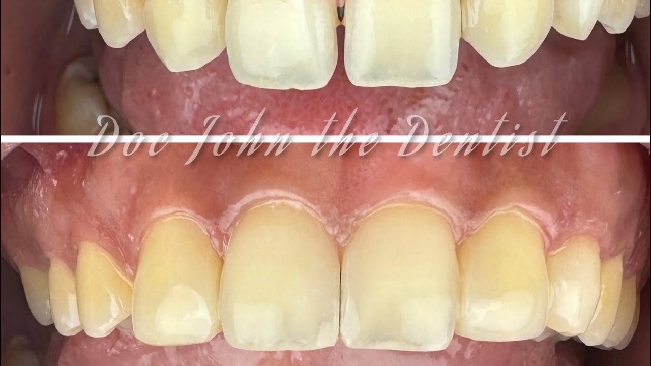 Composite Bonding (Space closure) - YouTube