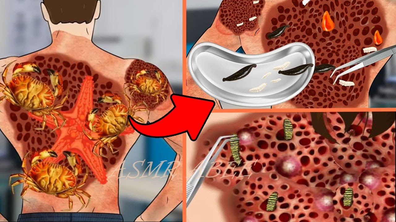 ASMR Treatment of Lice & Maggot Infections on Back & Arms | Pus Wound ...