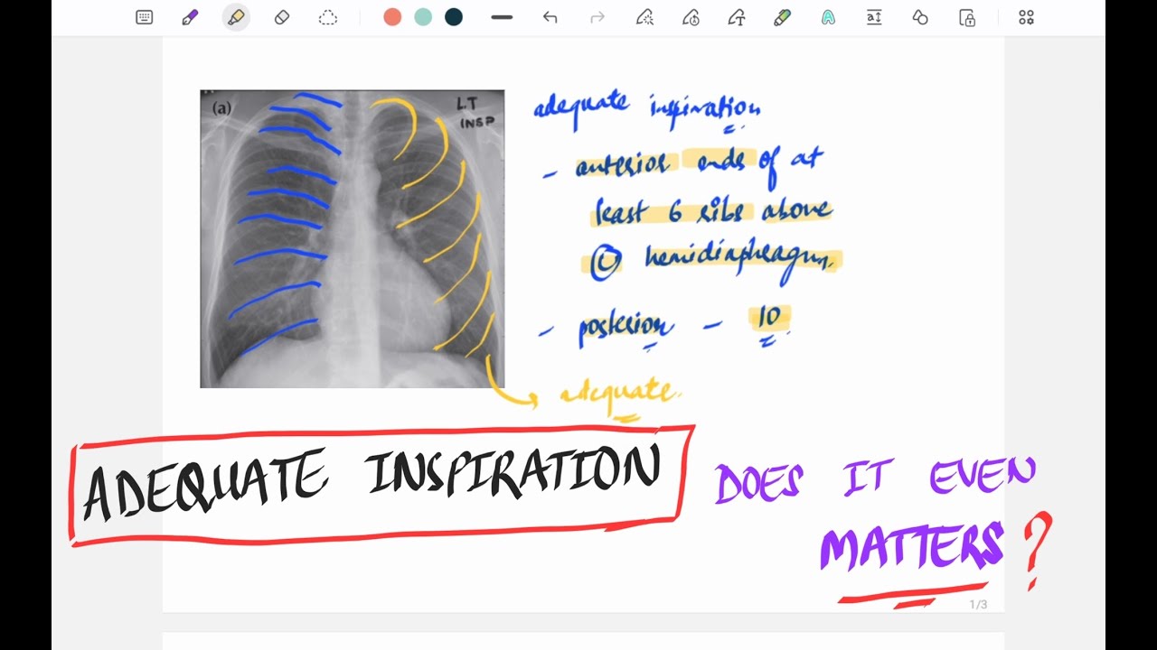 Adequate INSPIRATION on CHEST X RAY!! Does it even matter?? - YouTube