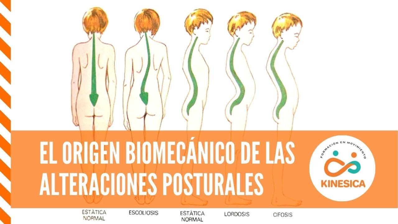 El Origen biomecánico de las alteraciones posturales - YouTube