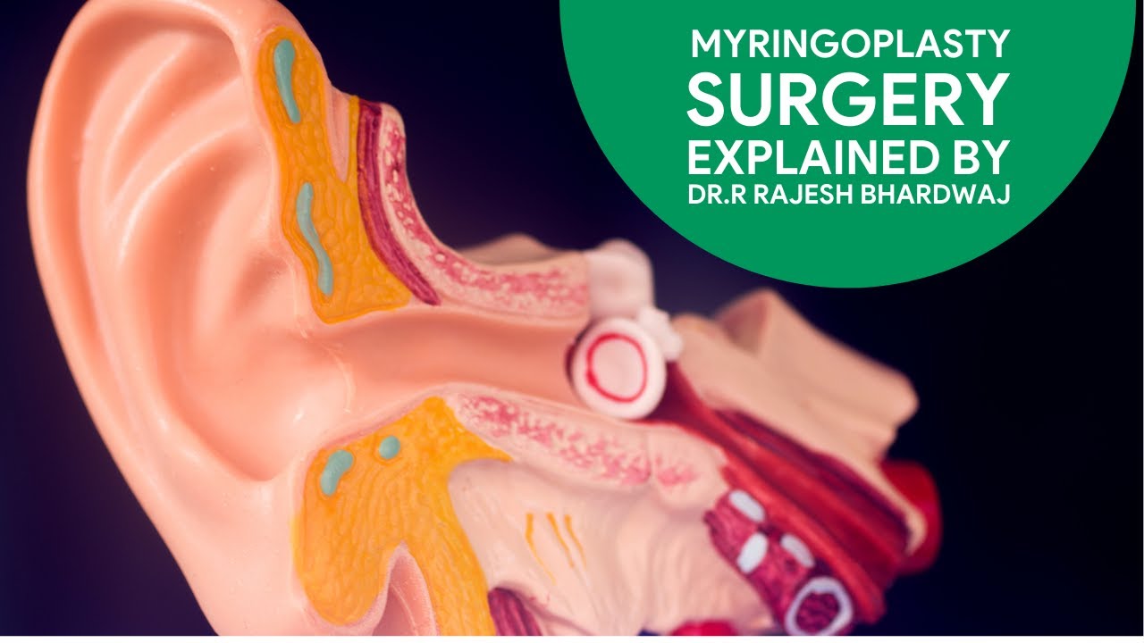 Myringoplasty (Eardrum Surgery) मायरिंगोप्लास्टी क्या है और इसका इलाज ...
