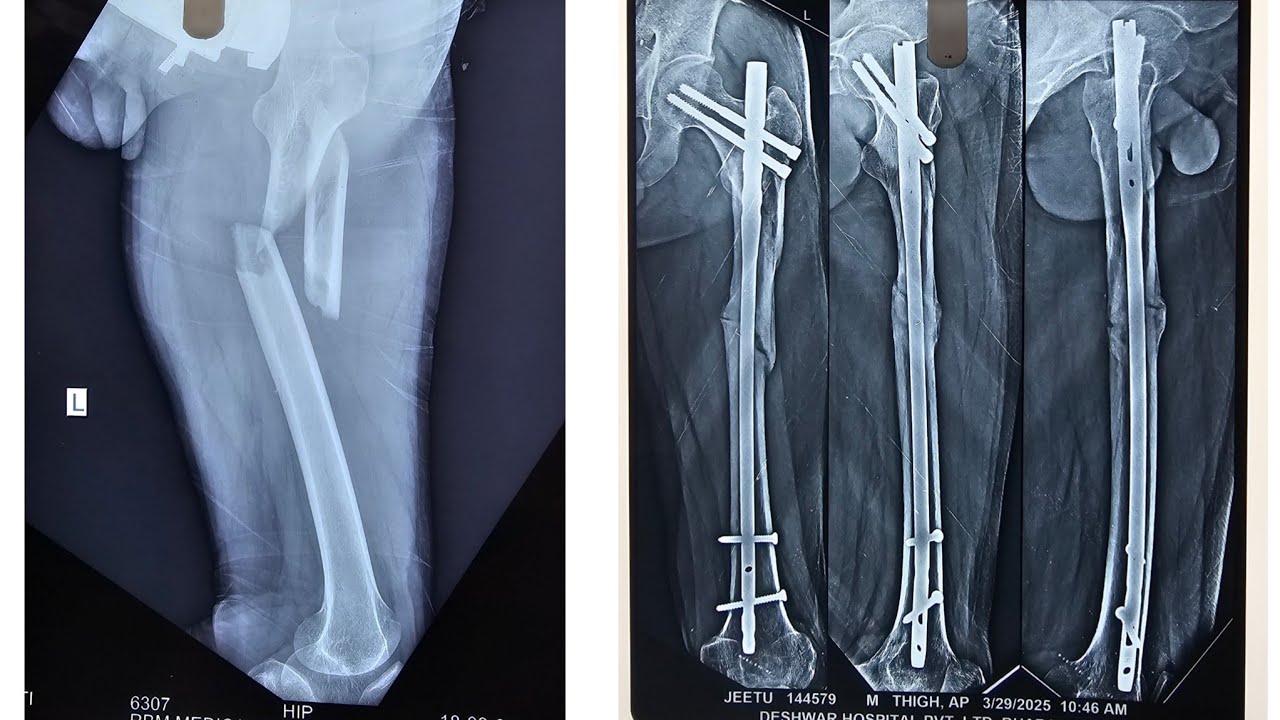 Femur bone segmental fracture Recovery Update after one year - YouTube