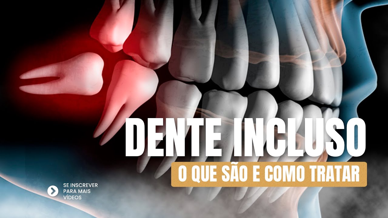 Dente Incluso: O Que São e Como Tratar? Descubra Tudo Aqui! - YouTube
