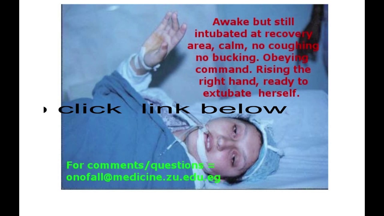 Awake extubation. Manually made tolerable endotracheal tube - YouTube