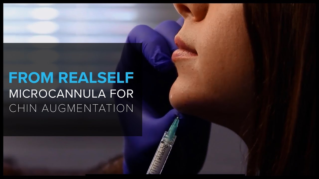 From RealSelf: "Do you use a microcannula for chin augmentation?" - YouTube