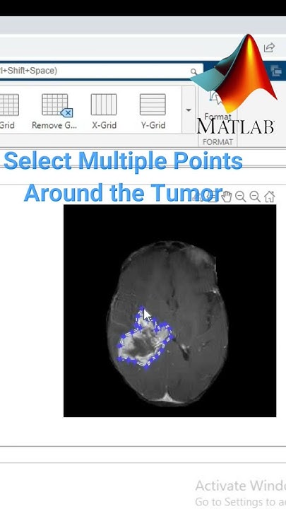 Extract Tumor by Image Segmentation MATLAB- DICOM image - YouTube