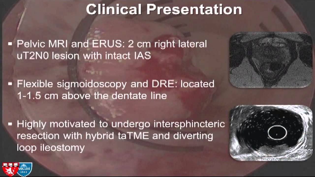 V021 ROBOTIC-ASSISTED TRANSANAL ENDOSCOPIC TOTAL MESORECTAL EXCISION ...