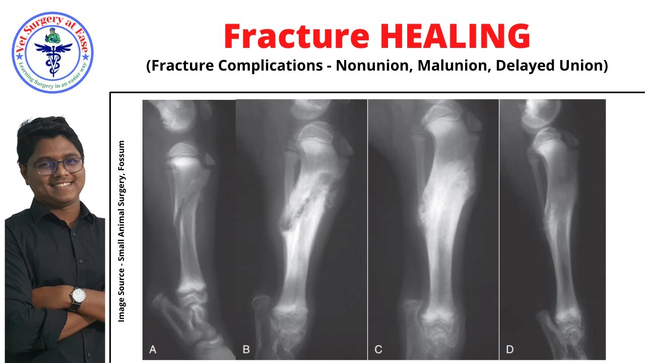 Fracture Healing | Lecture 10 | Orthopedics - YouTube
