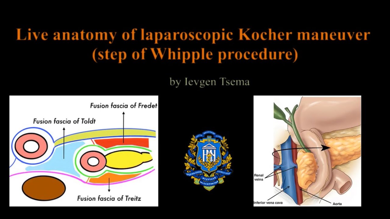 Live anatomy of laparoscopic Kocher maneuver (step of Wipple procedure ...