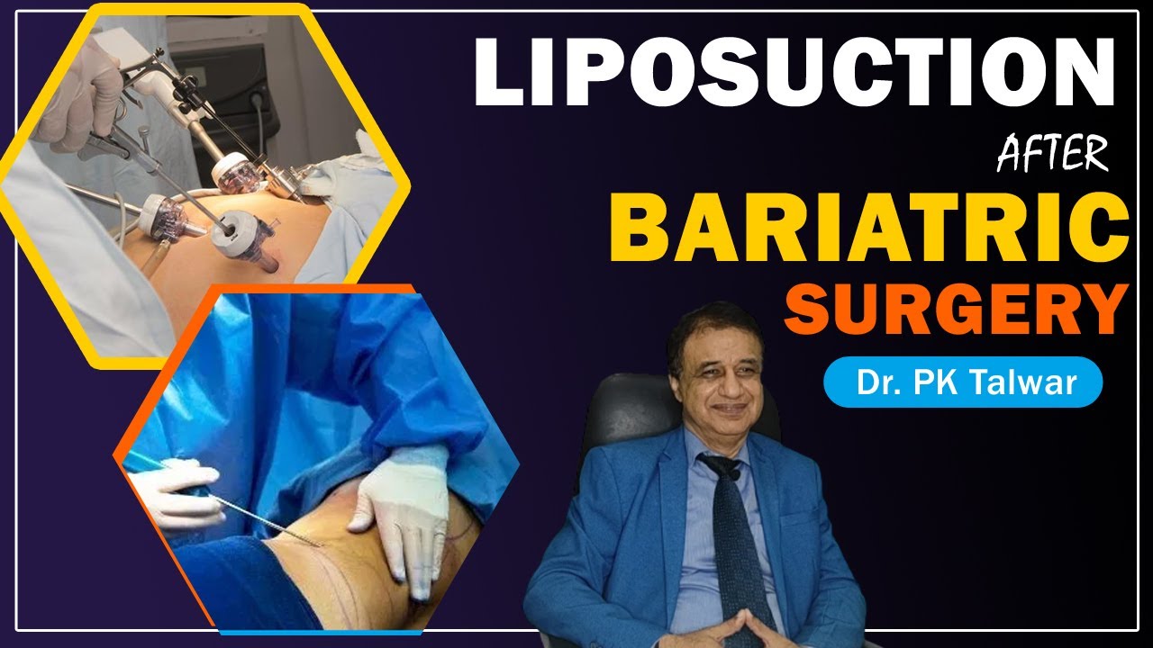 Liposuction After Bariatric Surgery, Can i Get Liposuction Surgery ...