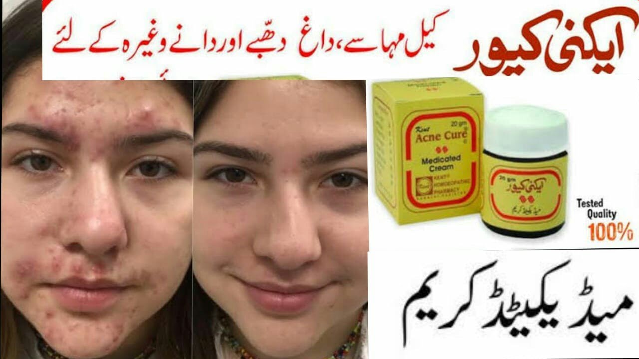 Best Acne Cream In Pakistan || Acne Cure Cream Review/ Acne treatment ...