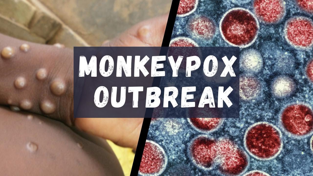Monkeypox Outbreak Escalates to Global Emergency #mpox - YouTube