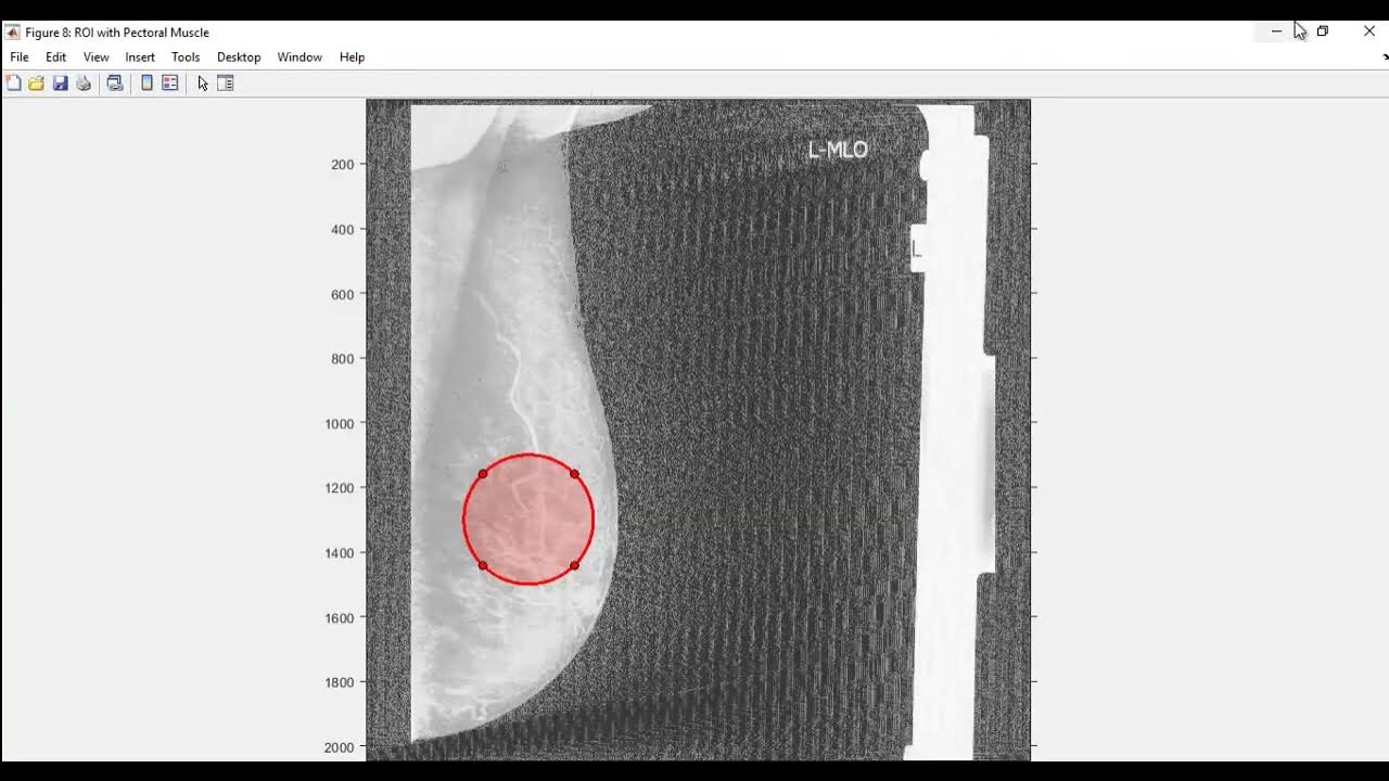Breast Cancer Detection in Mammogram Images using Deep Learning - YouTube