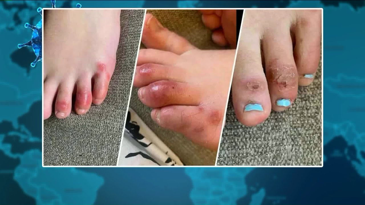 Dermatologist explains potential dangers of ‘COVID toes’ - YouTube