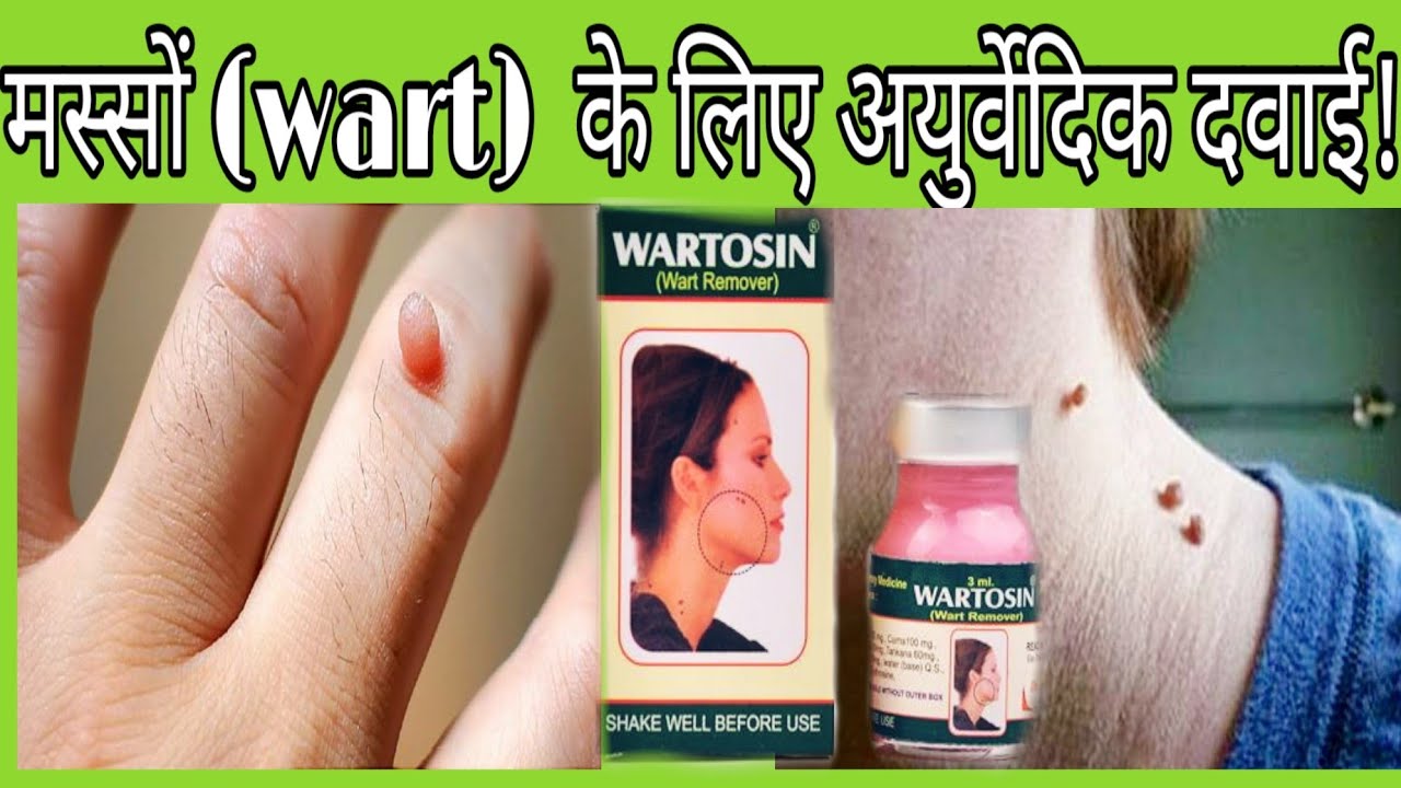 Wart remover lotion || मस्सों के लिए अयुर्वेदिक दवाई || Wartosin (wart ...