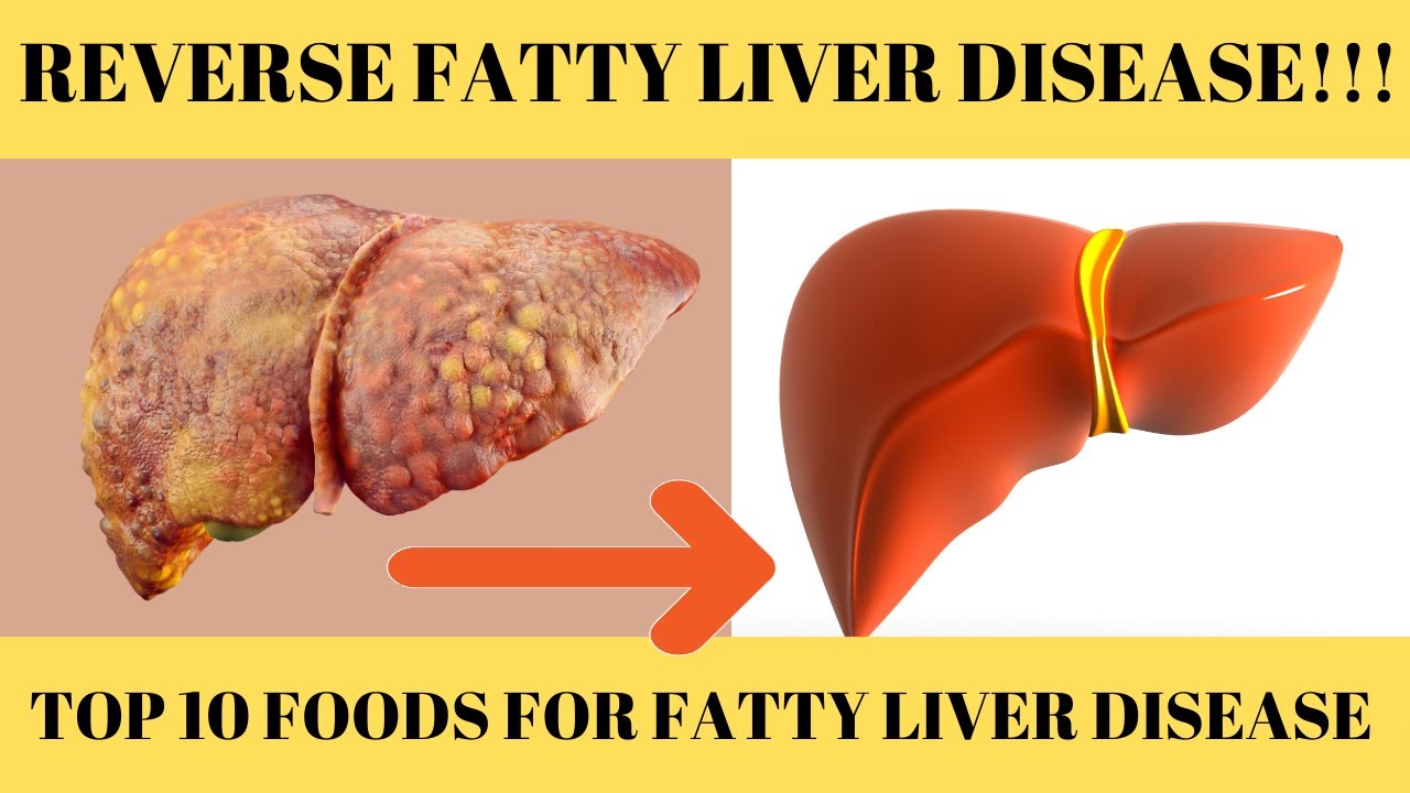 REVERSE FATTY LIVER DISEASE in these easy steps/ TOP 10 FOODS for FATTY ...