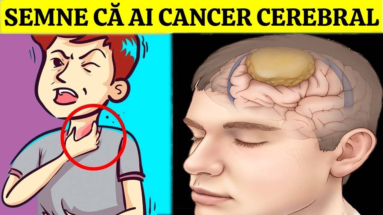 9 SEMNE ALARMANTE CĂ AI CANCER CEREBRAL - YouTube