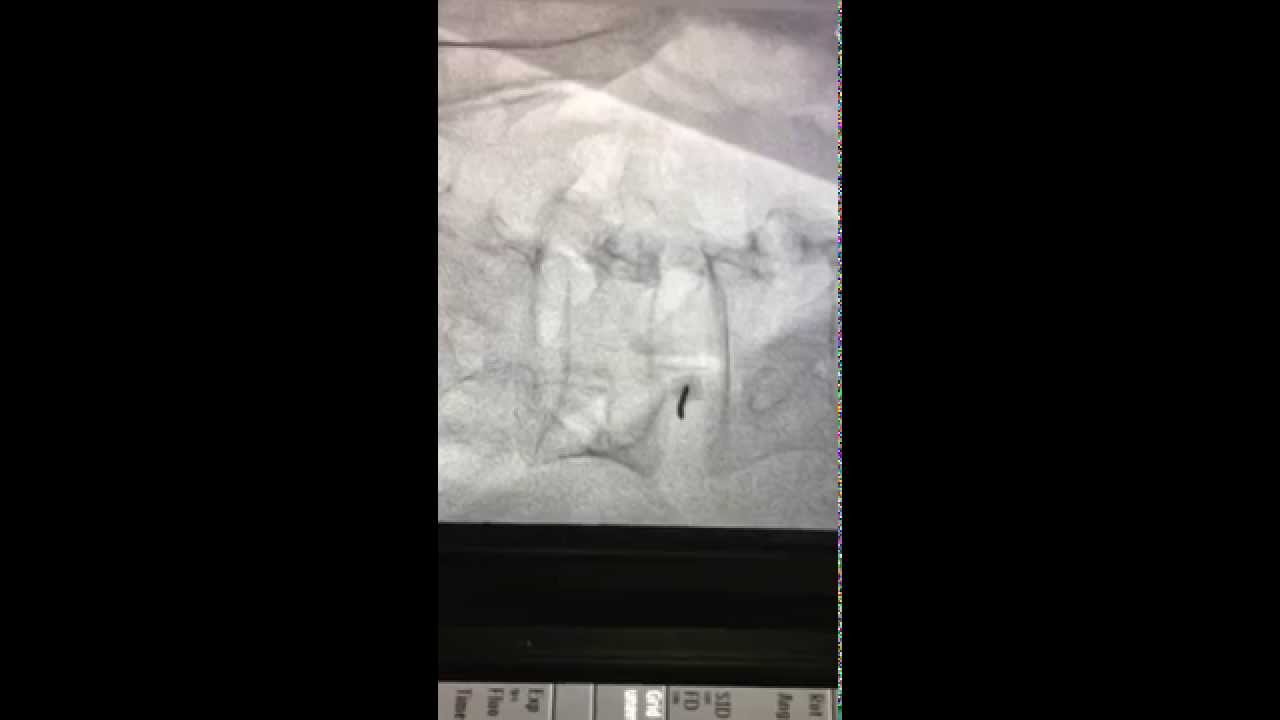 Lumbar Nucleoplasty Step 2 -- Nucleoplasty needle placement-Dr Rajesh ...