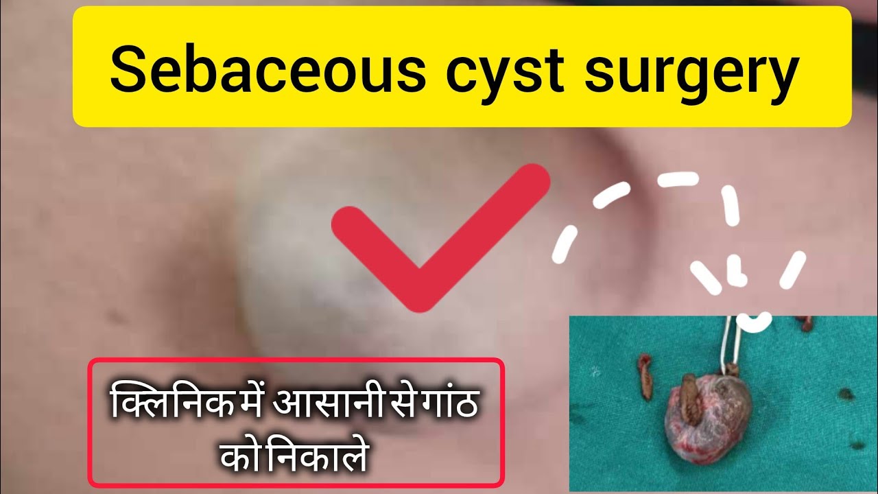 Sebaceous cyst removal surgery 😱🩺|Sebaceous cyst को कैसे निकाले # ...