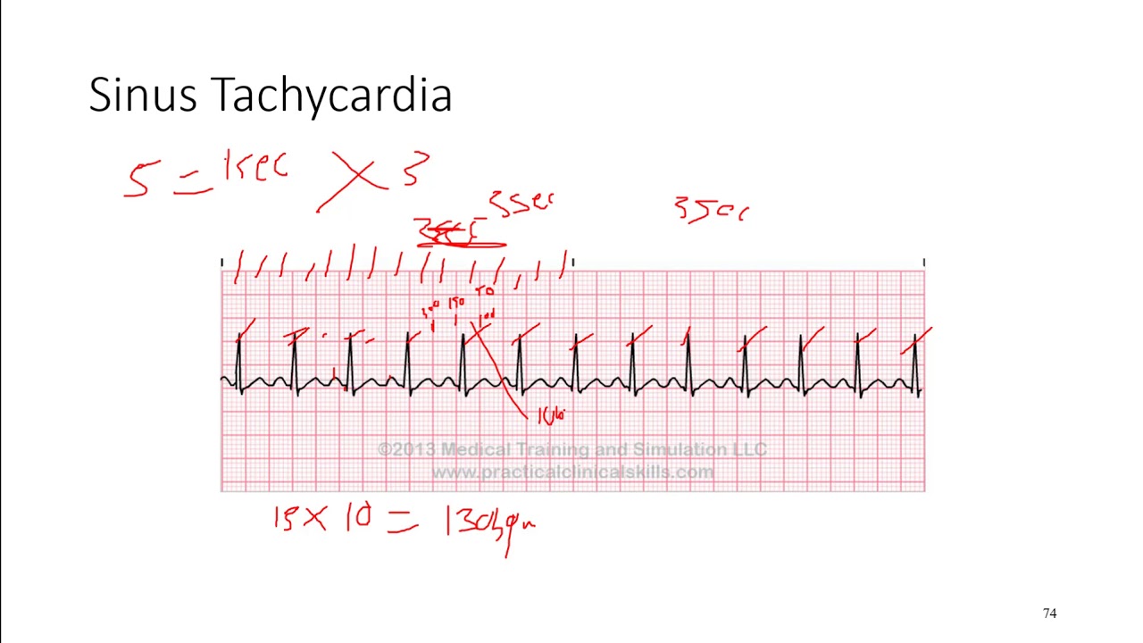 Supraventricular Tachycardia Vs Sinus Tachycardia