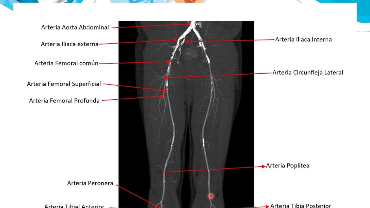 Angiogramadelaarteriatibialposterior