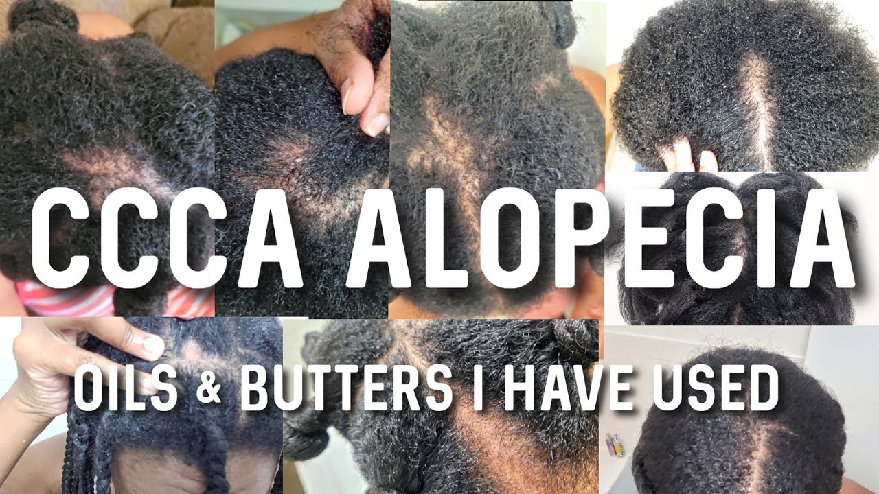 CCCA Alopecia Hair Care | Products I've Used #alopecia - YouTube