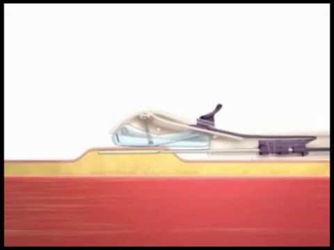 Incorrect Insertion 2 - Implanon NXT - YouTube