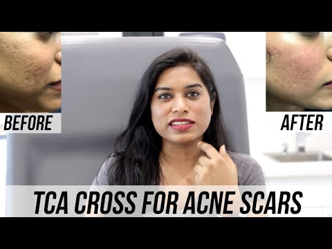 TCA Cross (Acne Scar Treatment) - YouTube