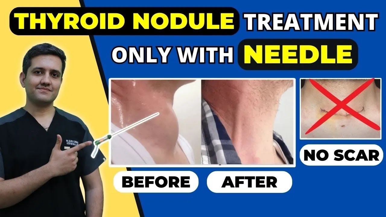 THYROID NODULE TREATMENT WITHOUT SURGERY | COLLOID GOITER TREATMENT ...
