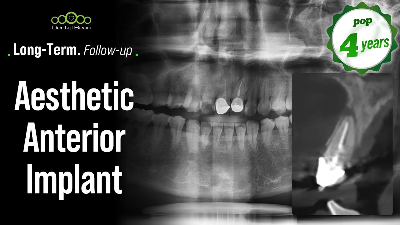 Successful Immediate Implant Placement in the Esthetic Zone [Dr. Cho ...