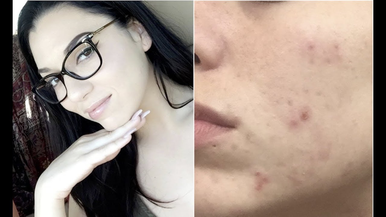 Accutane review month 1 & 2 + tips AMAZING RESULTS! - YouTube