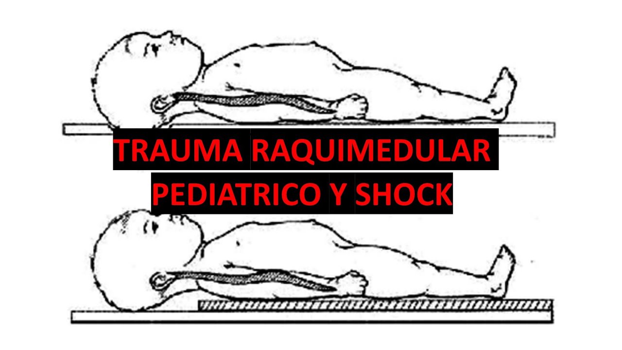TRAUMA RAQUIMEDULAR en NIÑOS y SHOCK: Qué hay que saber? Qué es SCIWORA ...