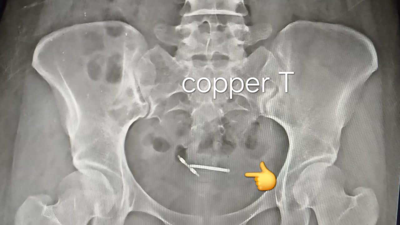 Copper T IUCD Malposition: Horizontal Orientation Explained with ...