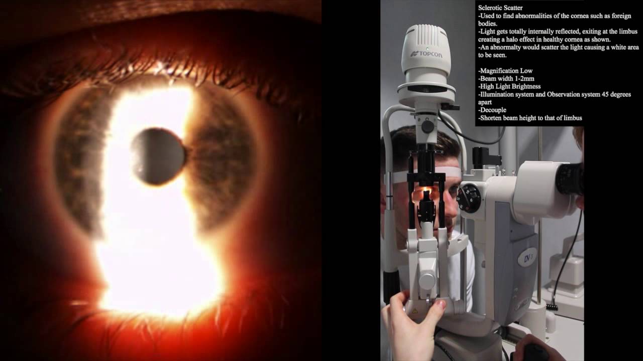 Slit Lamp: Sclerotic scatter - YouTube