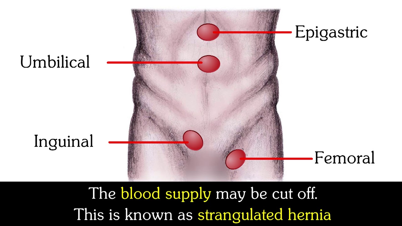 What Is Hernia Abdominal Hernia Types Of Hernia Hernia Repair Youtube