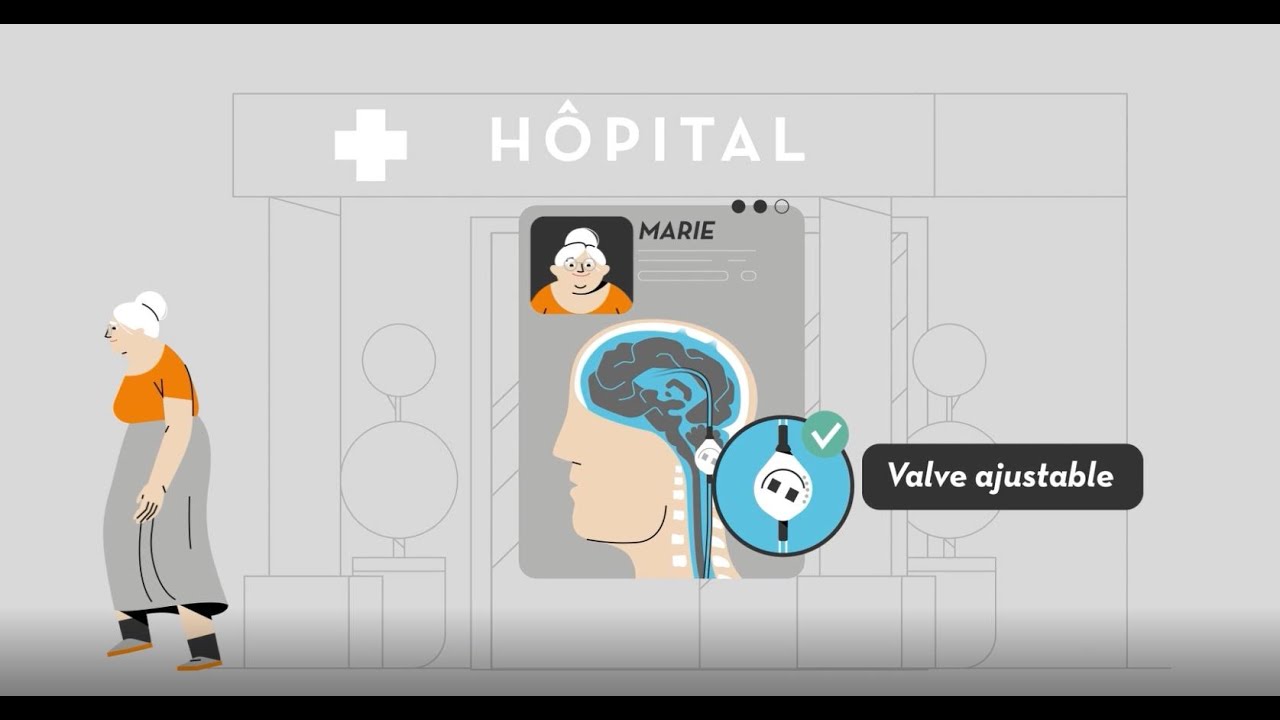 Le traitement de l'hydrocéphalie: du diagnostique à la pose de valve ...