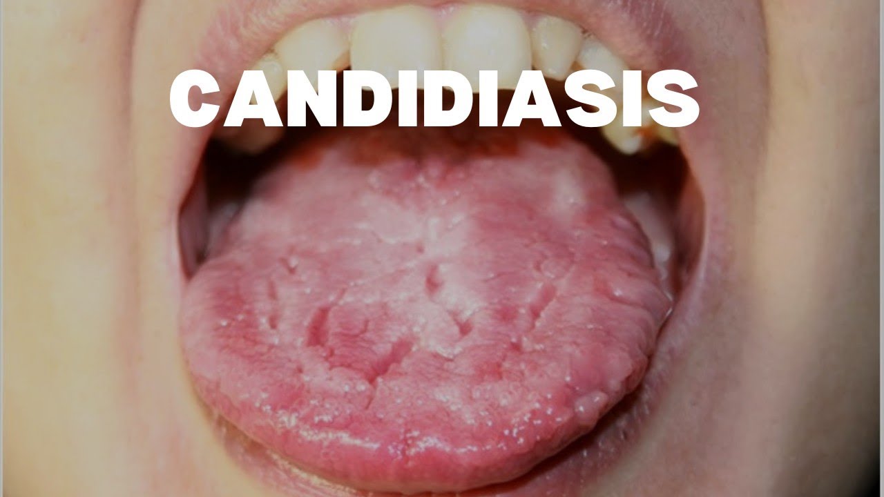 Classification & Management of Oral Candidiasis & Angular Chelitis ...