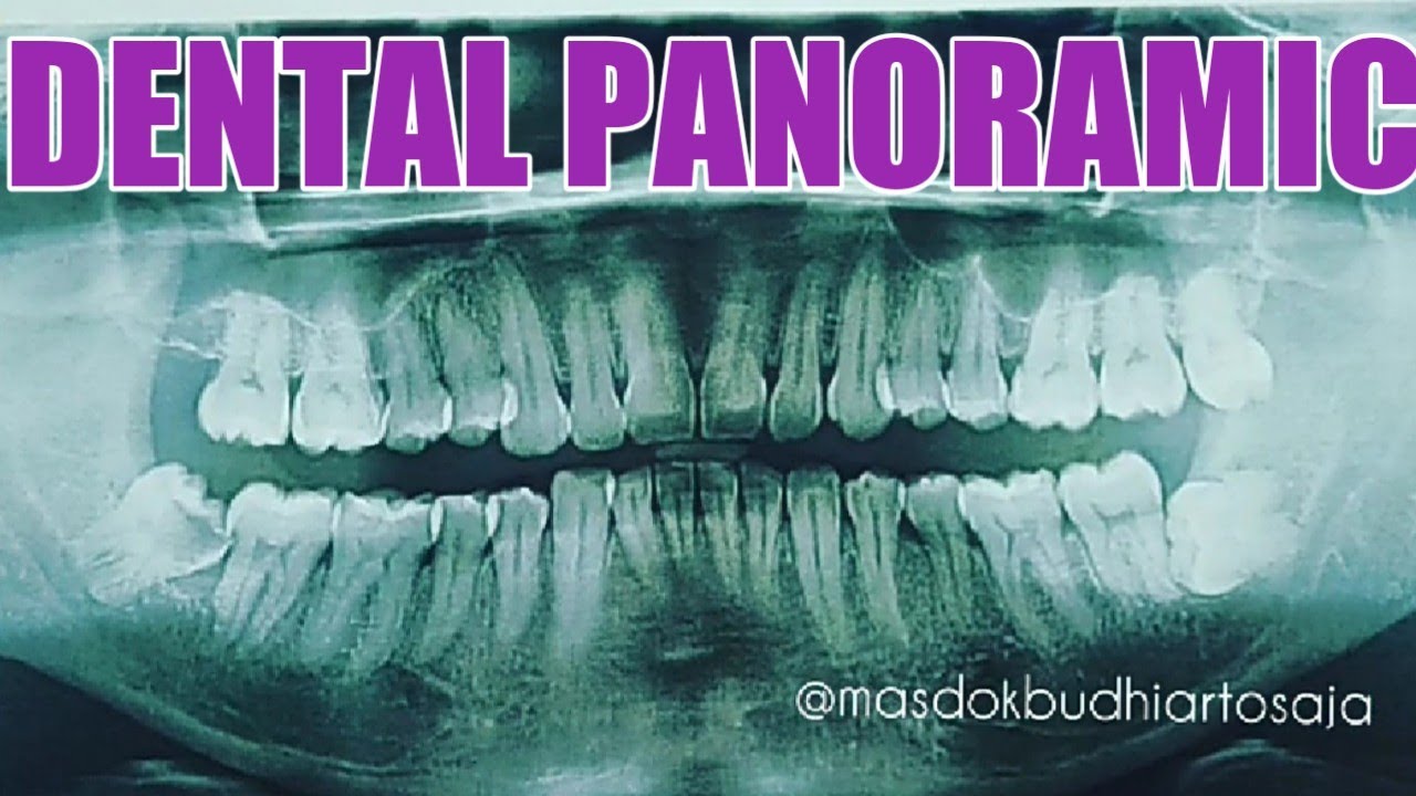 penampakan ronsen gigi foto panoramic #shorts - YouTube