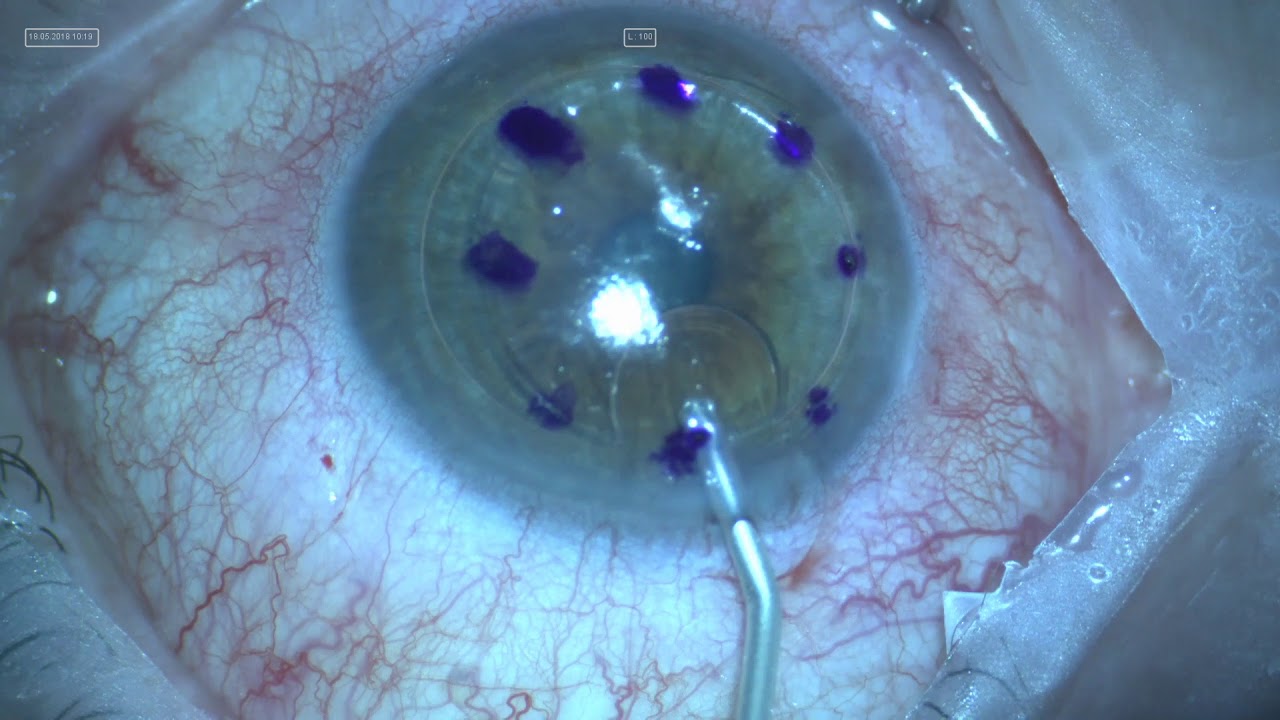 DMEK IN PHAKIC EYE - YouTube