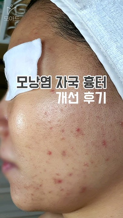 모낭염 여드름 자국 흉터 개선 후기 건대 피부관리 모아드 Youtube