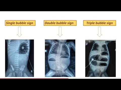 Abdominal X-Rays (Intestinal Obstruction) | Pediatrics - YouTube
