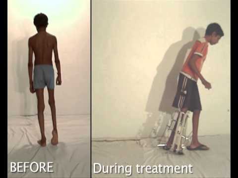 Polio with shortening and Deformity Foot - YouTube