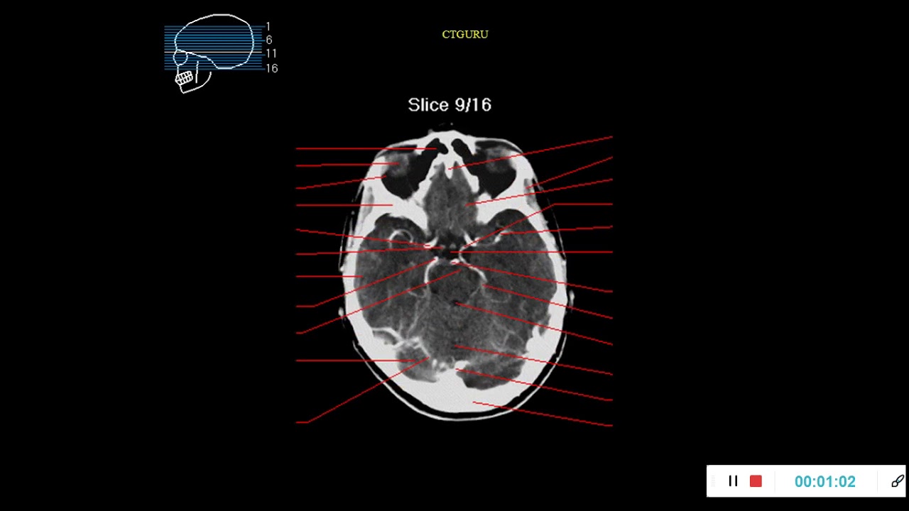 BASIC CT ANATOMY OF THE BRAIN WITH SOFT WINDOW - YouTube