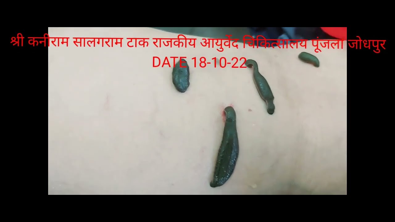 JALOKA THERAPY (LEECH THERAPY)AT JODHPUR #varicosevein #painrelief # ...