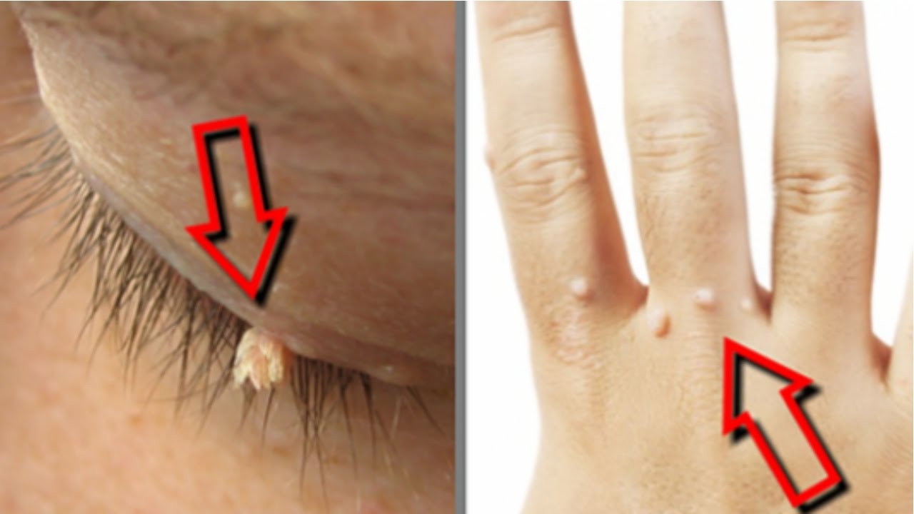 MOST EFFECTIVE HOMEMADE REMEDIES FOR REMOVING WARTS - YouTube