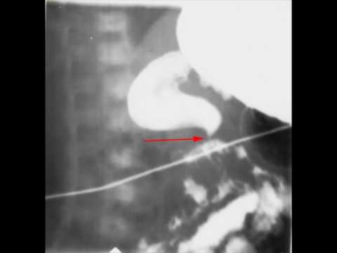 Intestinal Malrotation And Midgut Volvulus In A 1month