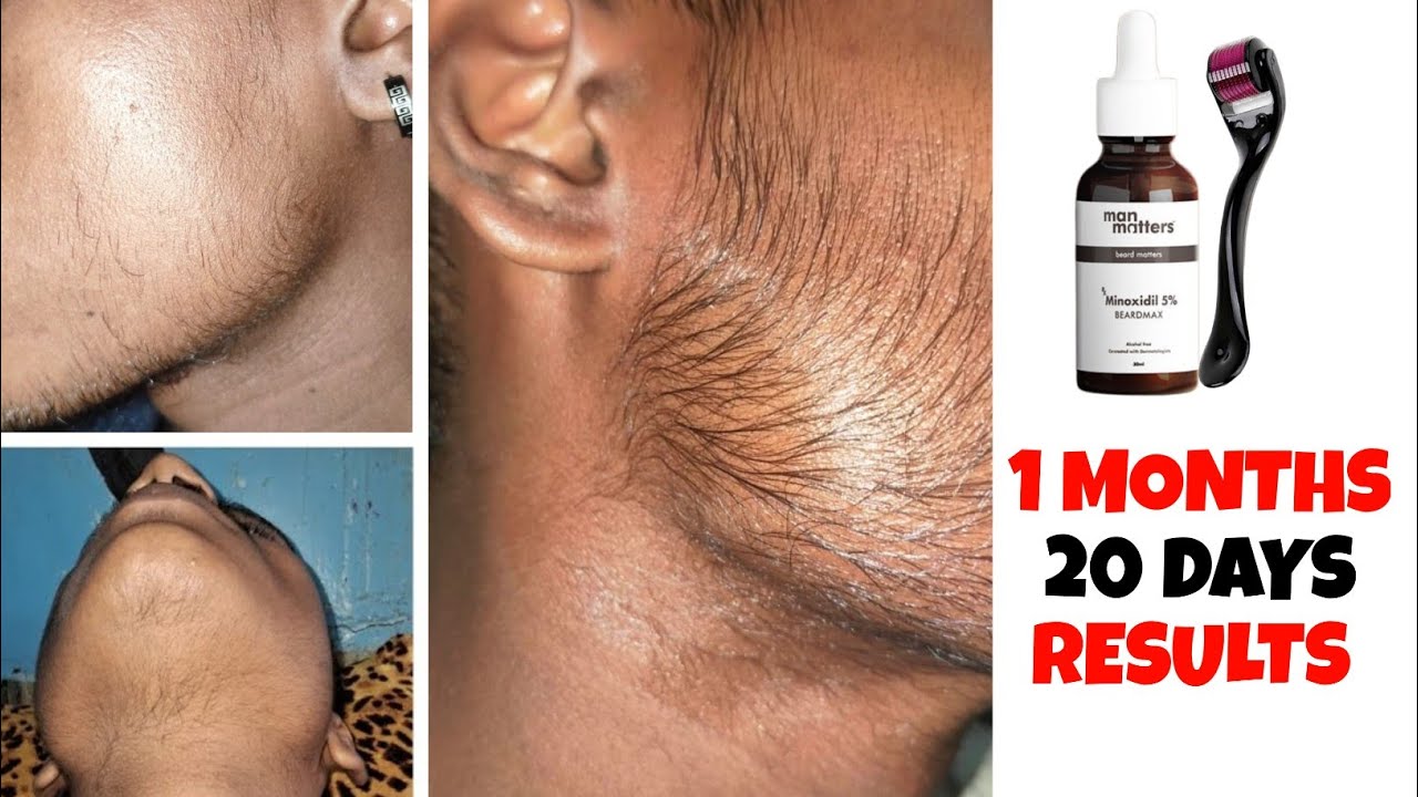 1 months 20 days result after use man matters minoxidil | man matters ...