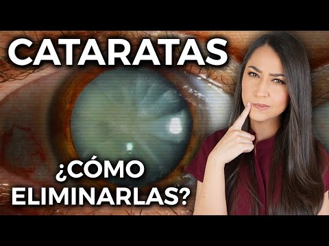 Así se eliminan las CATARATAS 👁 l Todo lo que tienes que saber 👩🏻‍⚕️@drapauzuniga