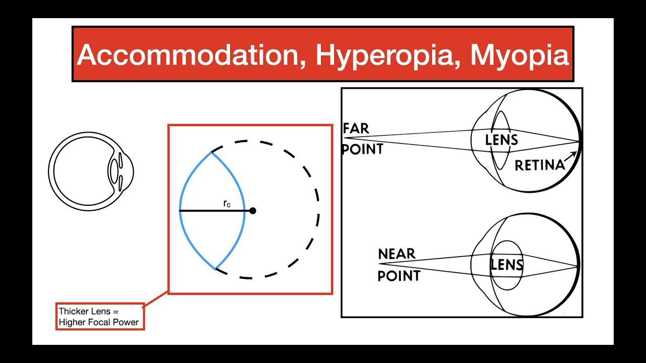 Accommodation, Hyperopia, Myopia - YouTube