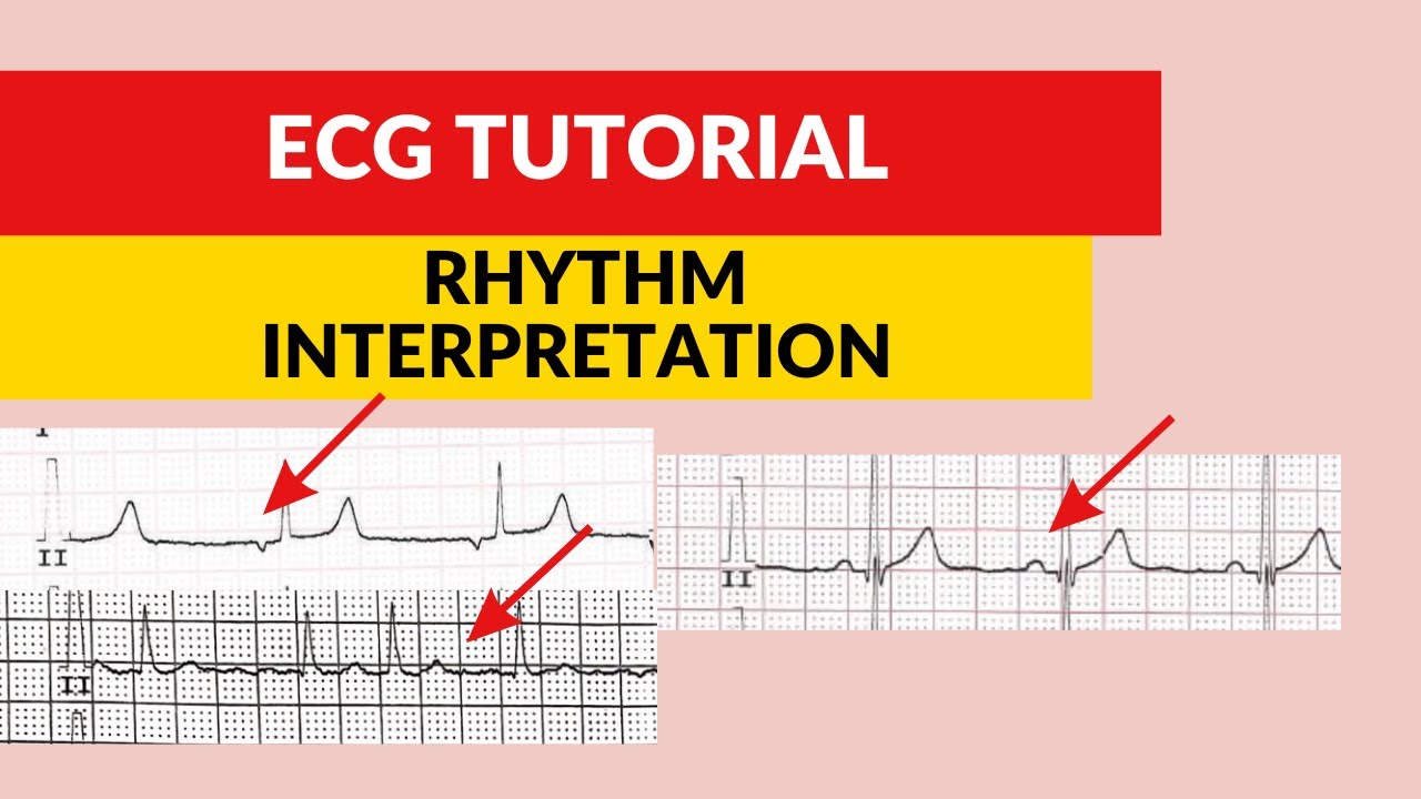 Heart rhythm ECG/EKG interpretation. Sinus rhythm. Nodal rhythm. Atrial ...